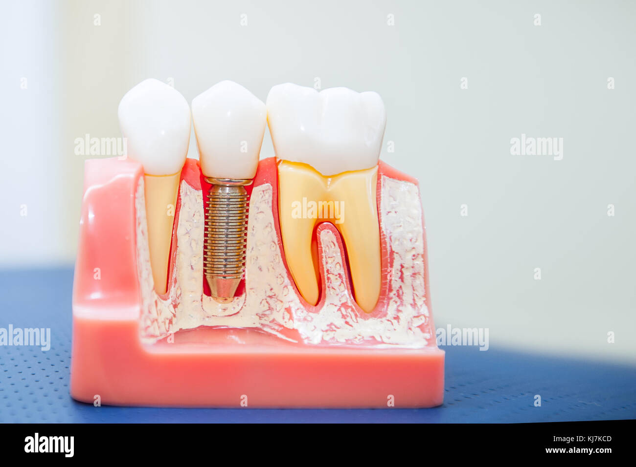 Close up Human tooth implant, crown model. Modern stomatology concept ...