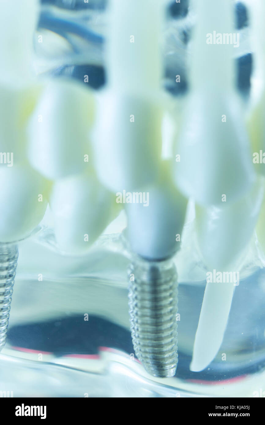 Dental titanium aesthetic orthodontic tooth implant in dentists mouth ...