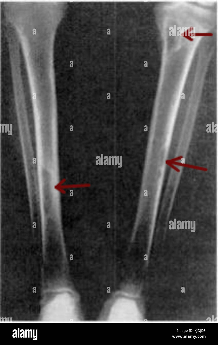 Osteitis fibrosa cystica tibiae X ray Stock Photo - Alamy