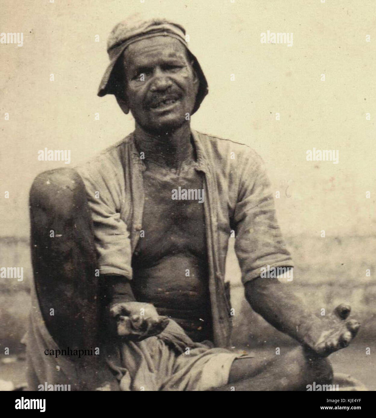 Leper man hi-res stock photography and images - Alamy