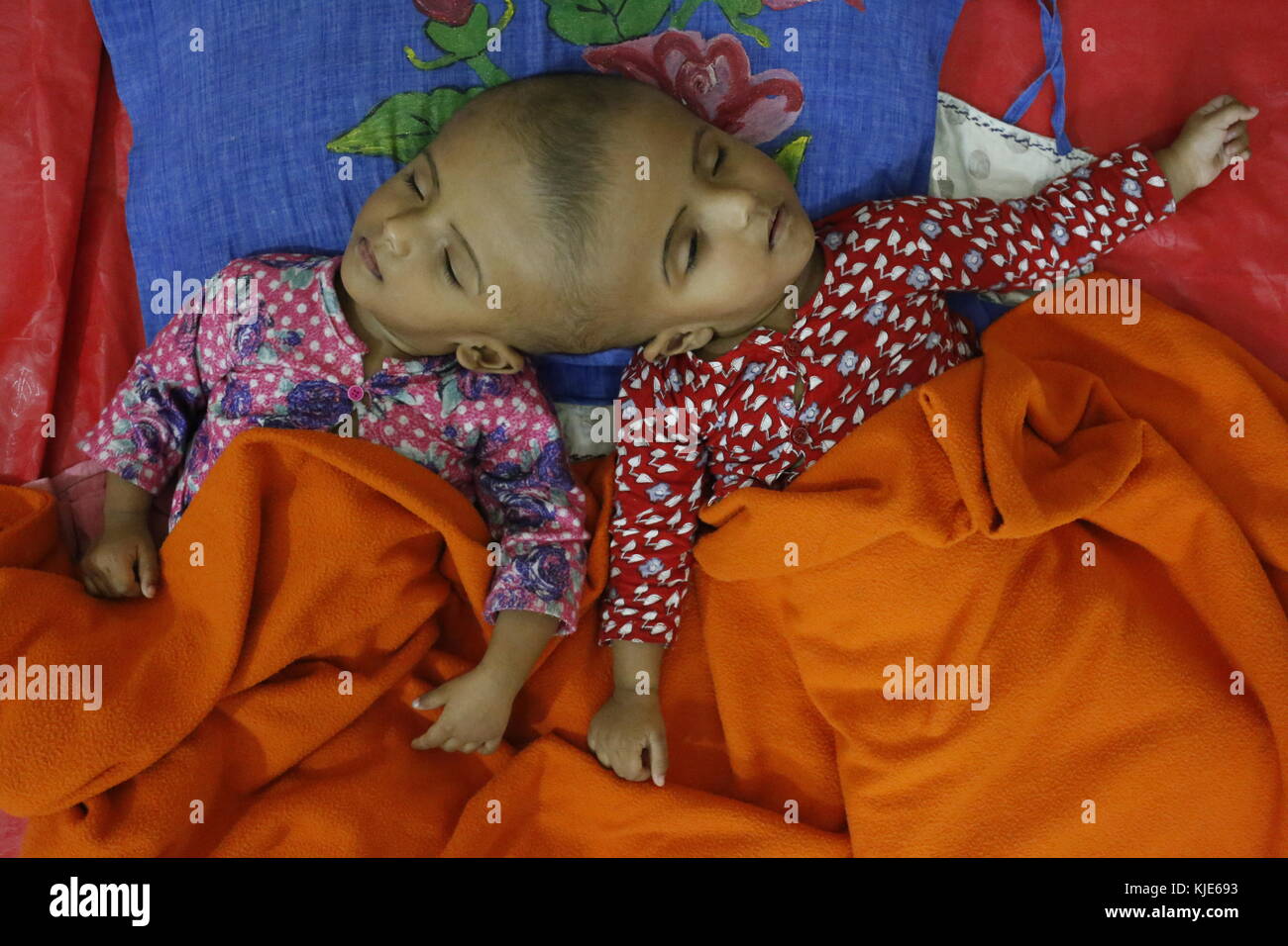 Conjoined Twins At The Head