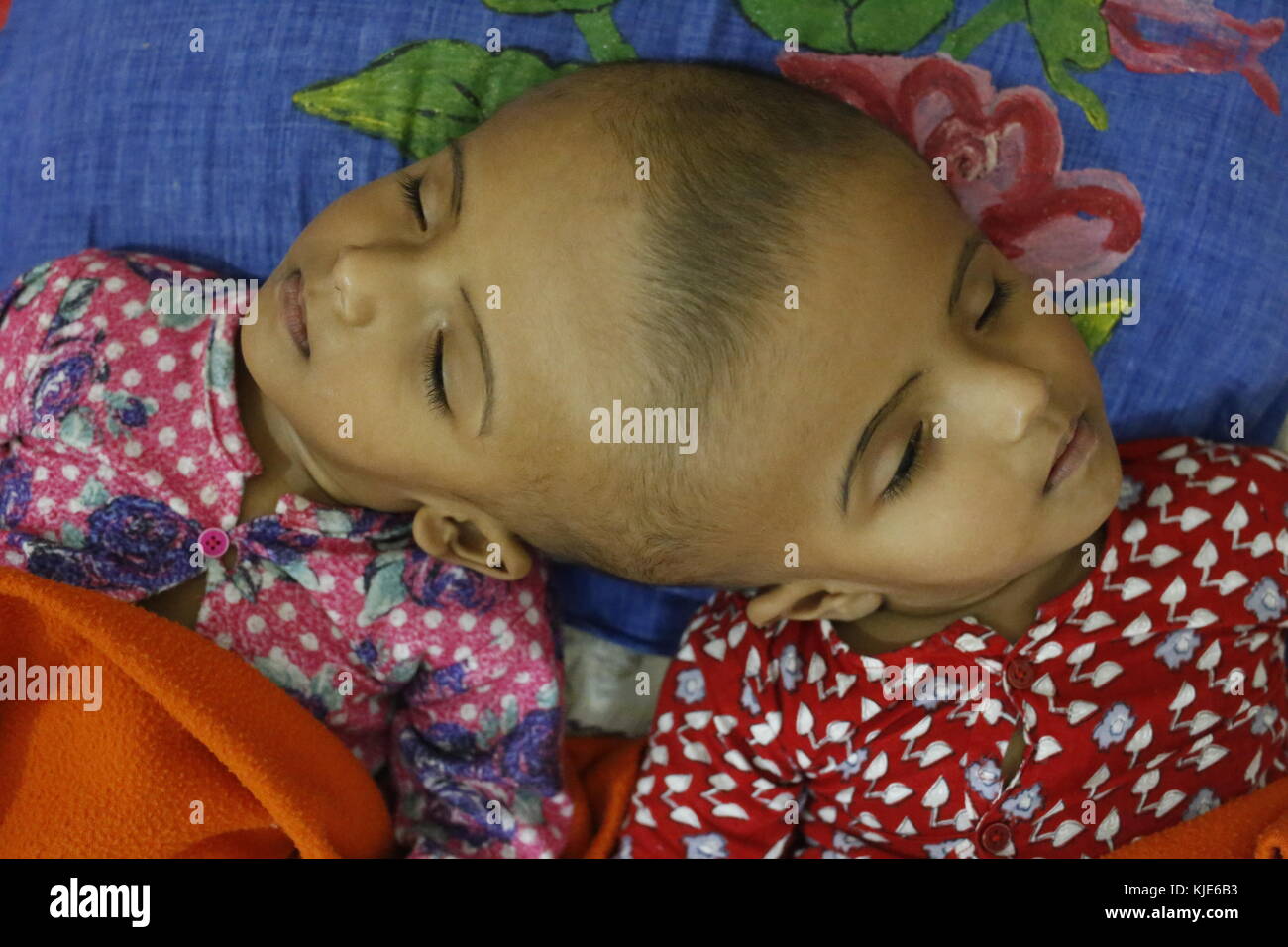 Conjoined twins head hi-res stock photography and images - Alamy