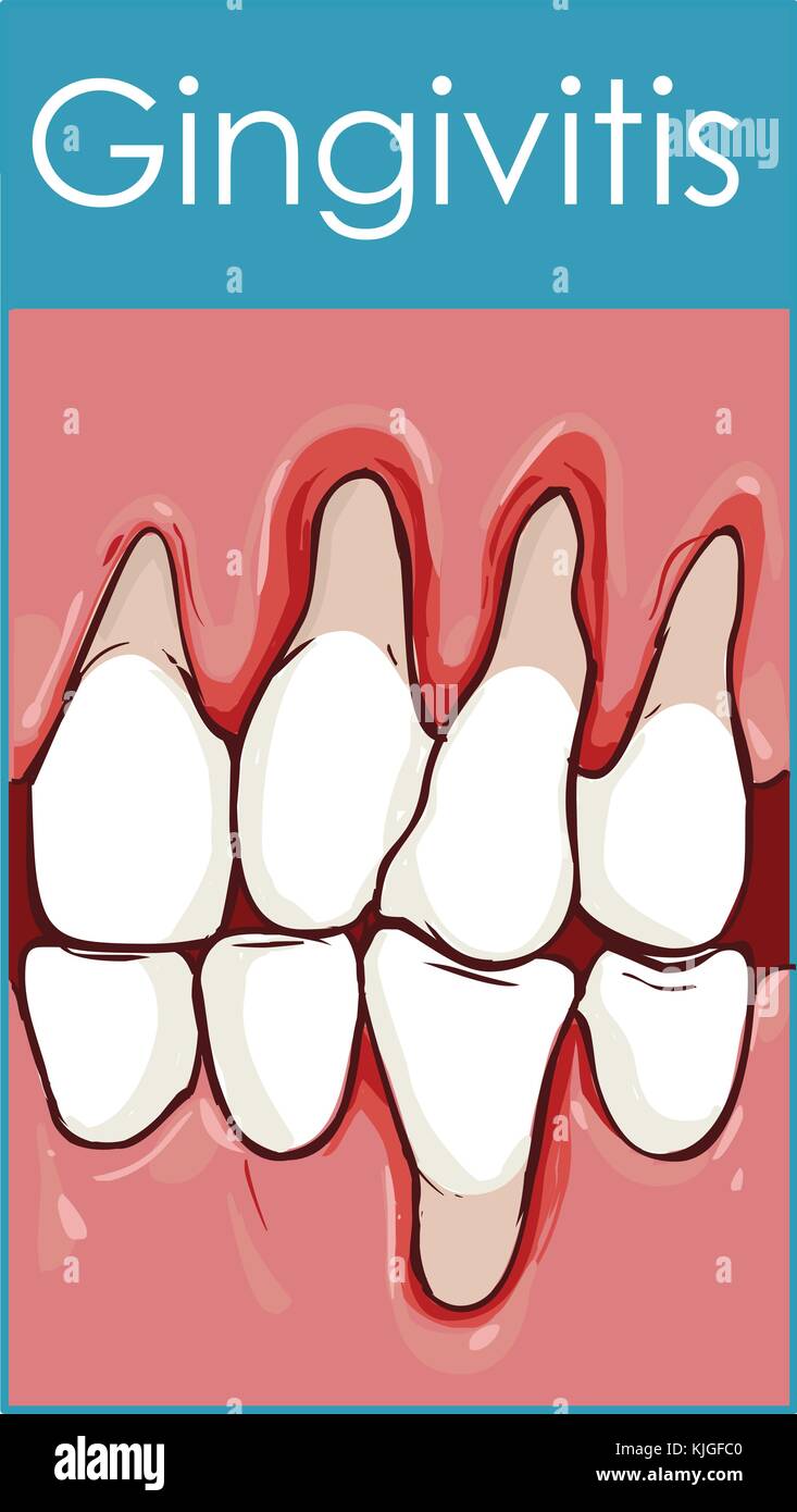 Gingivitis. Inflammation of the gums. Vector illustration on isolated ...
