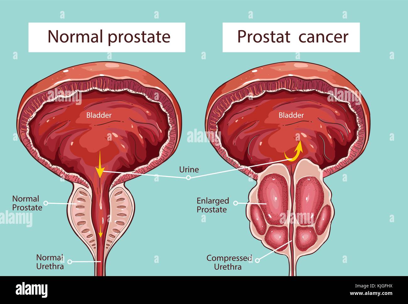 normal prostate and acute prostatitis. Medical illustration Stock Vector Image & Art - Alamy