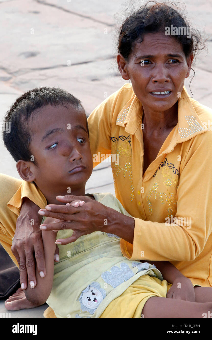 Khmer woman and hydrocephalic child begging outside Angkor wat ...