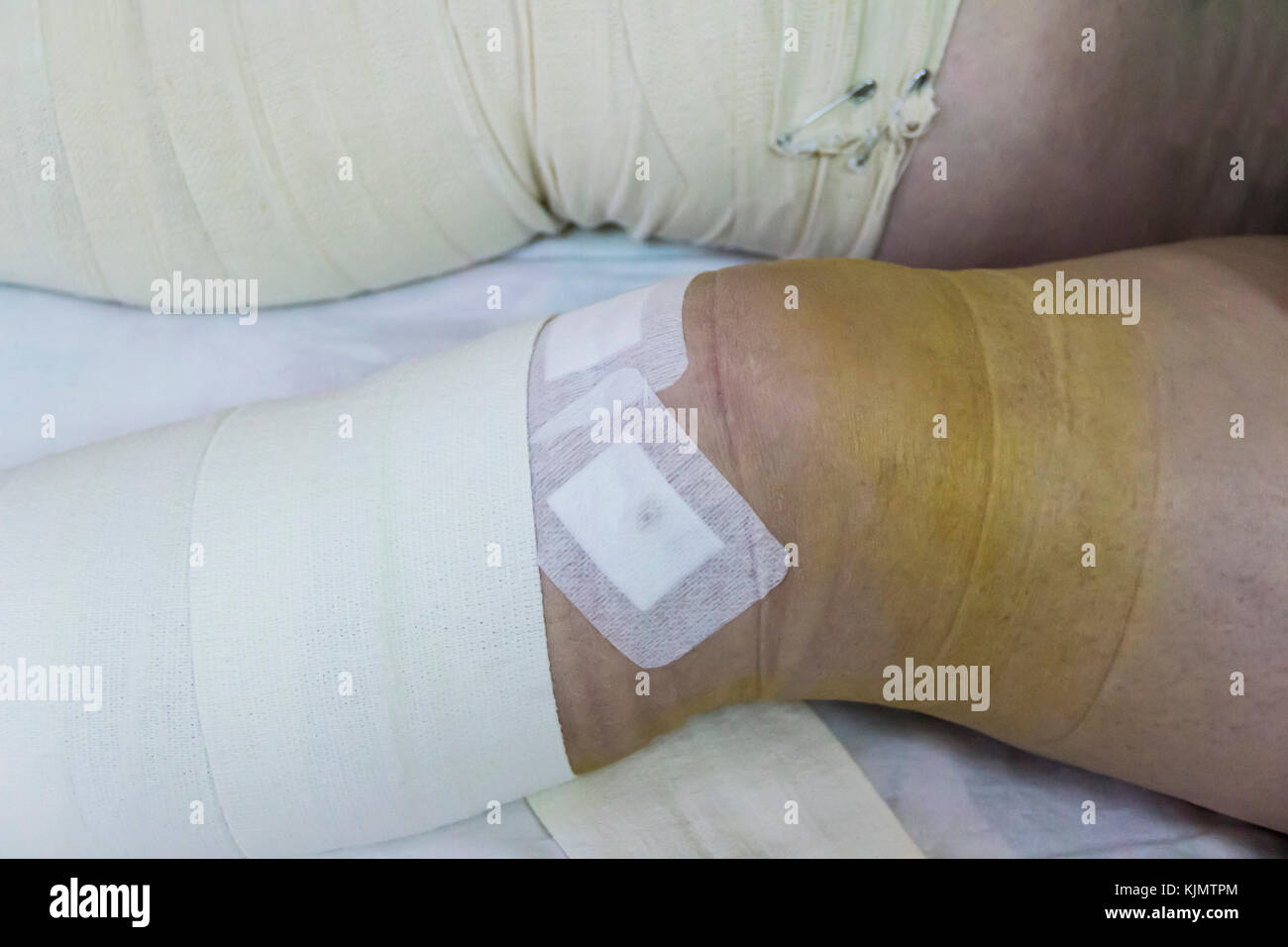 Photo of the two legs with bandage Stock Photo - Alamy