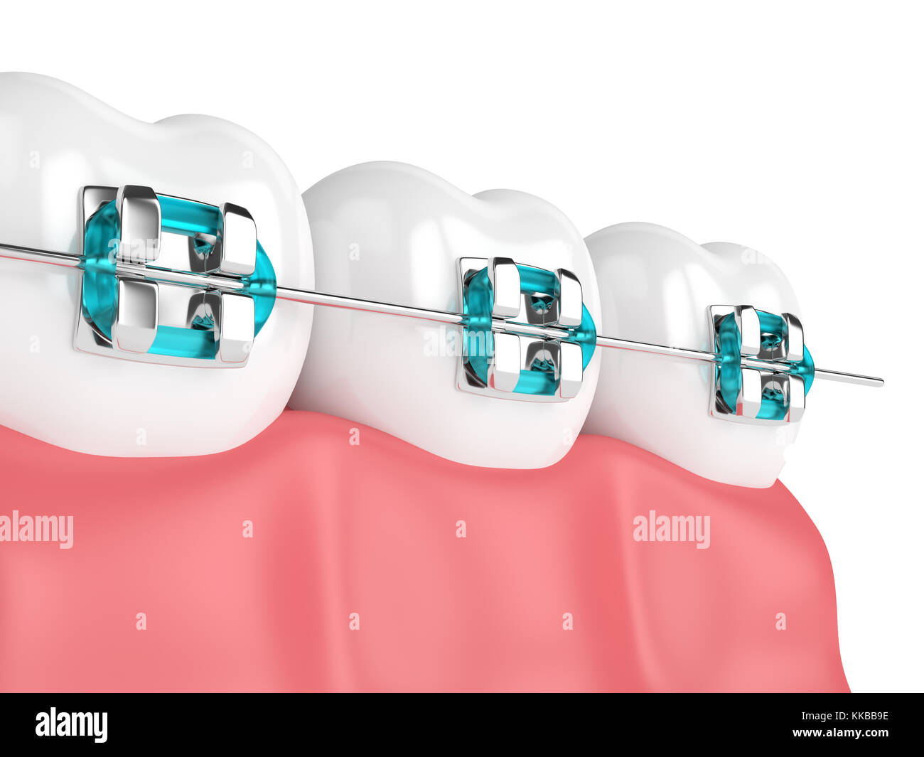 3d render of teeth with braces isolated over white background Stock ...