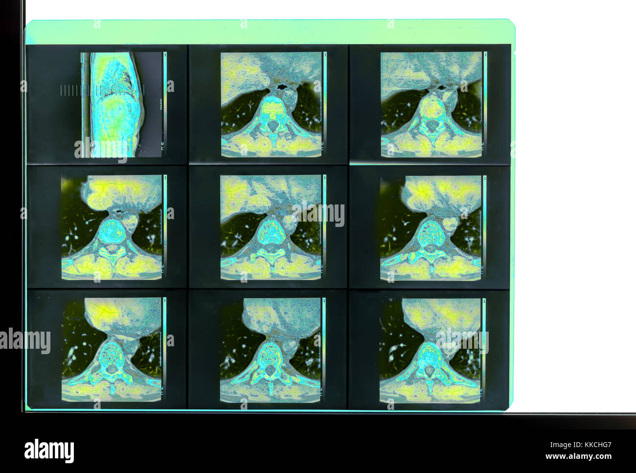Colored CT scan result on the computer screen with green background ...