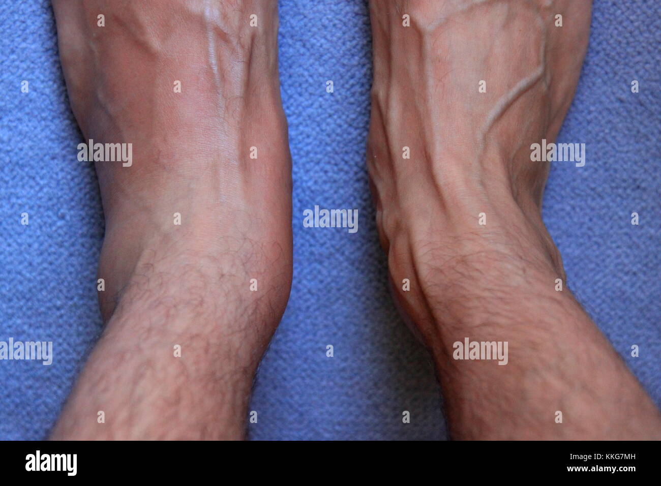 Swollen ankle hi-res stock photography and images - Alamy
