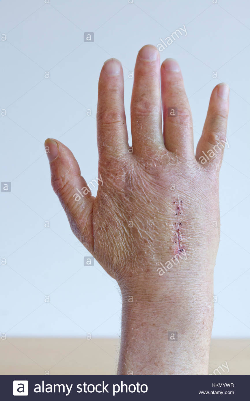 Bone Fracture Healing Stock Photos & Bone Fracture Healing Stock Images ...