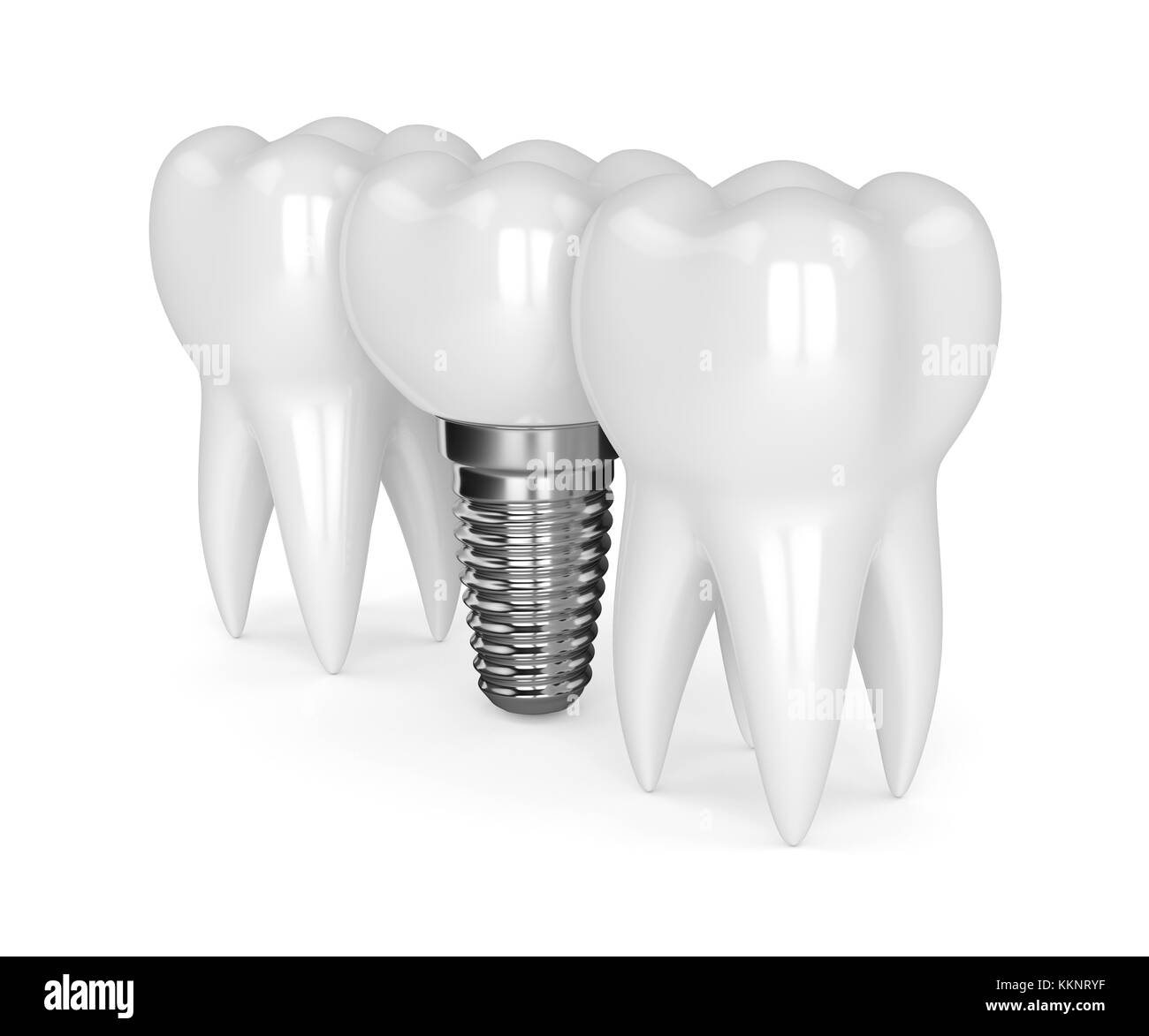 3d tooth implantation Black and White Stock Photos & Images - Alamy