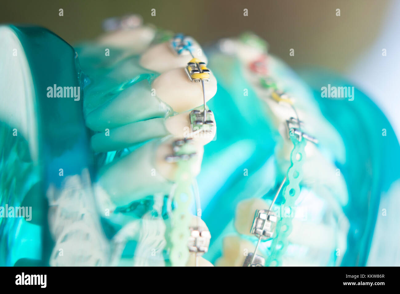 Dental teeth retainers metal aligners brackets to straighten teeth in ...