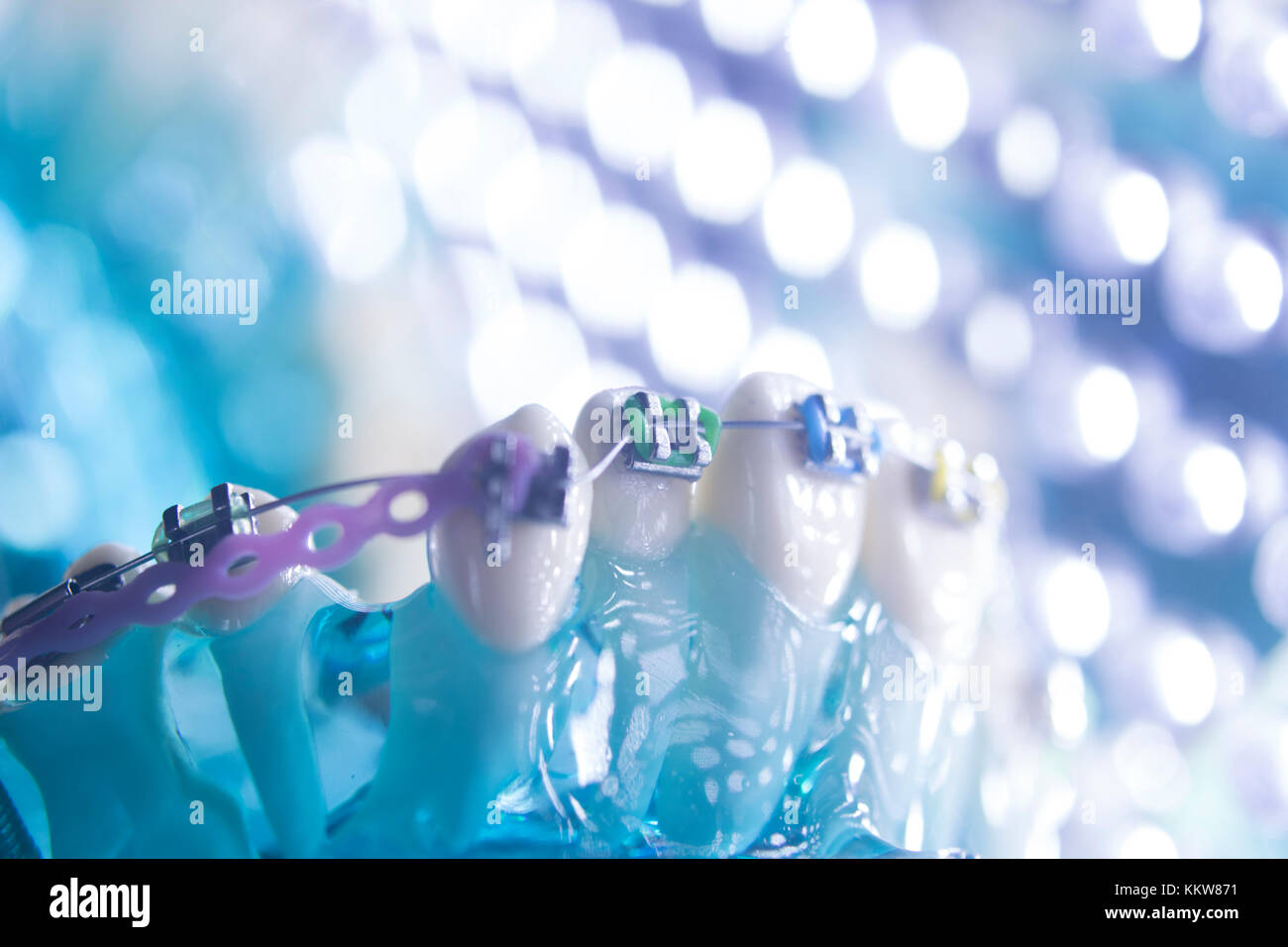 Dental teeth retainers metal aligners brackets to straighten teeth in ...