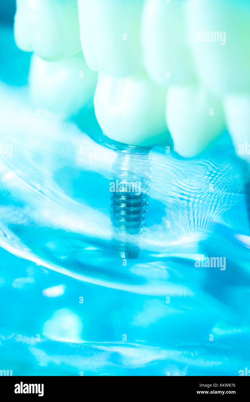 Dental titanium aesthetic orthodontic tooth implant in dentists mouth ...