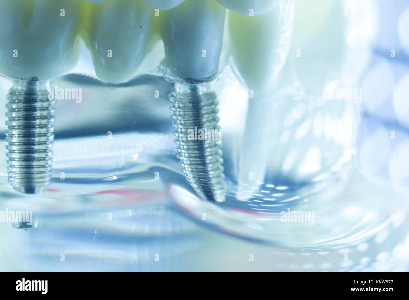 Dental titanium aesthetic orthodontic tooth implant in dentists mouth ...