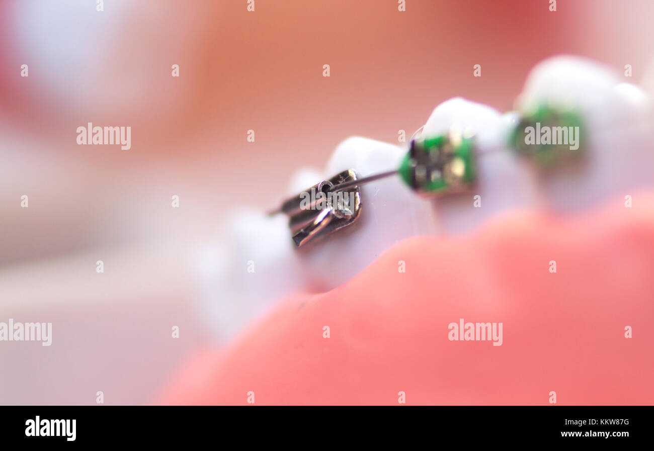 Cosmetic dentistry orthodontics dental metal wire teeth brackets ...