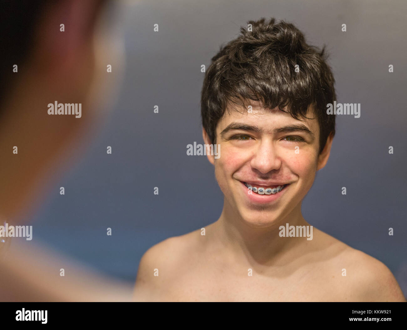 teen with braces and acne skin smiling in mirror Stock Photo - Alamy