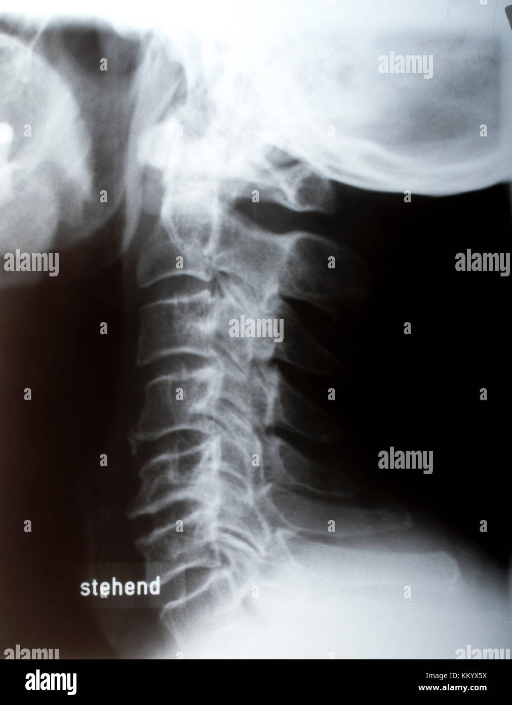Human neck sidelong in x-ray Stock Photo - Alamy