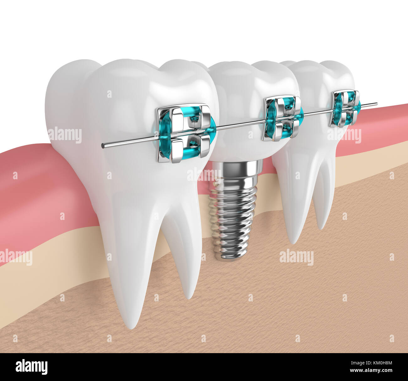3d render of teeth with dental implant and braces in gums Stock Photo ...