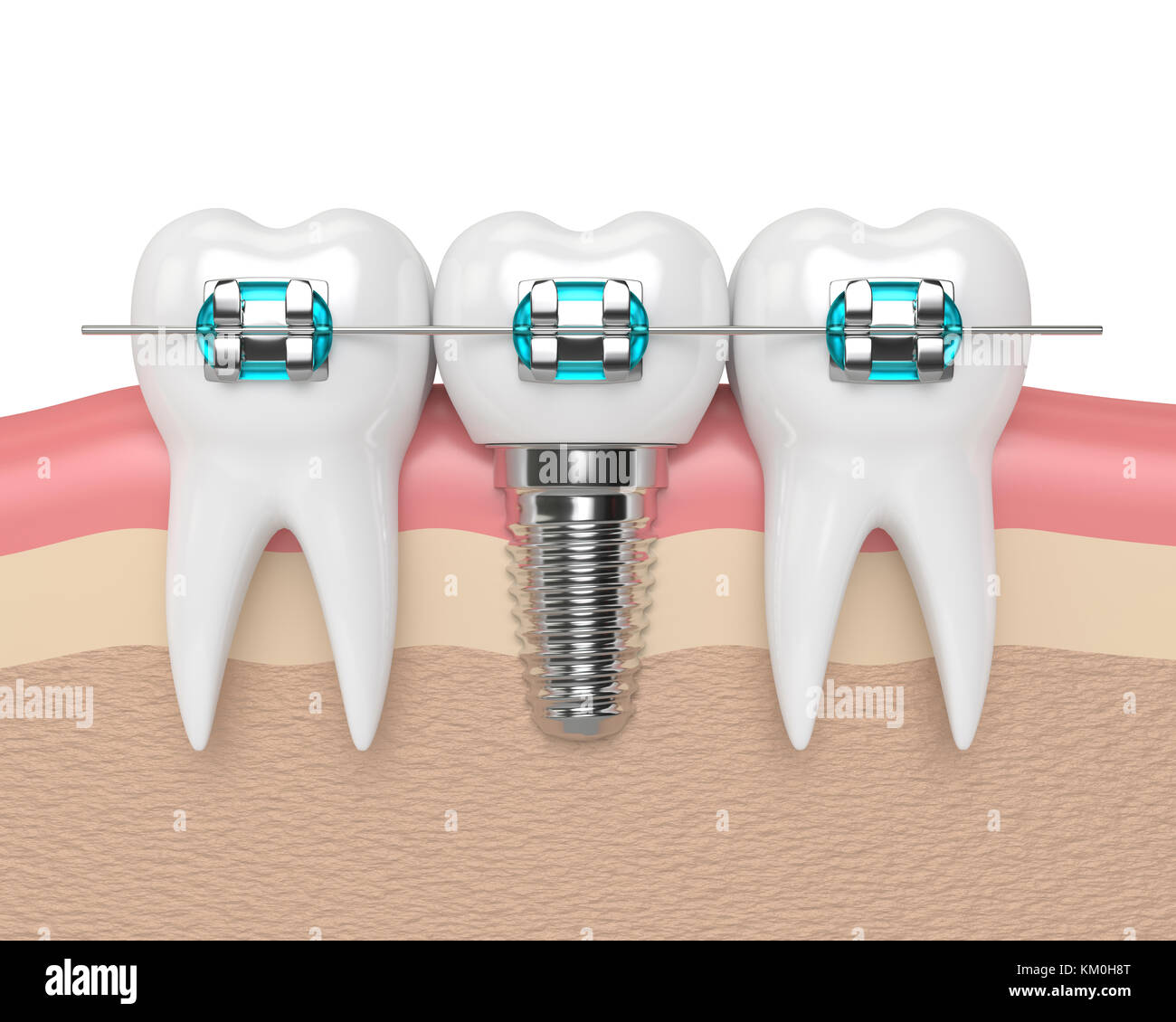 3d render of teeth with dental implant and braces in gums Stock Photo ...