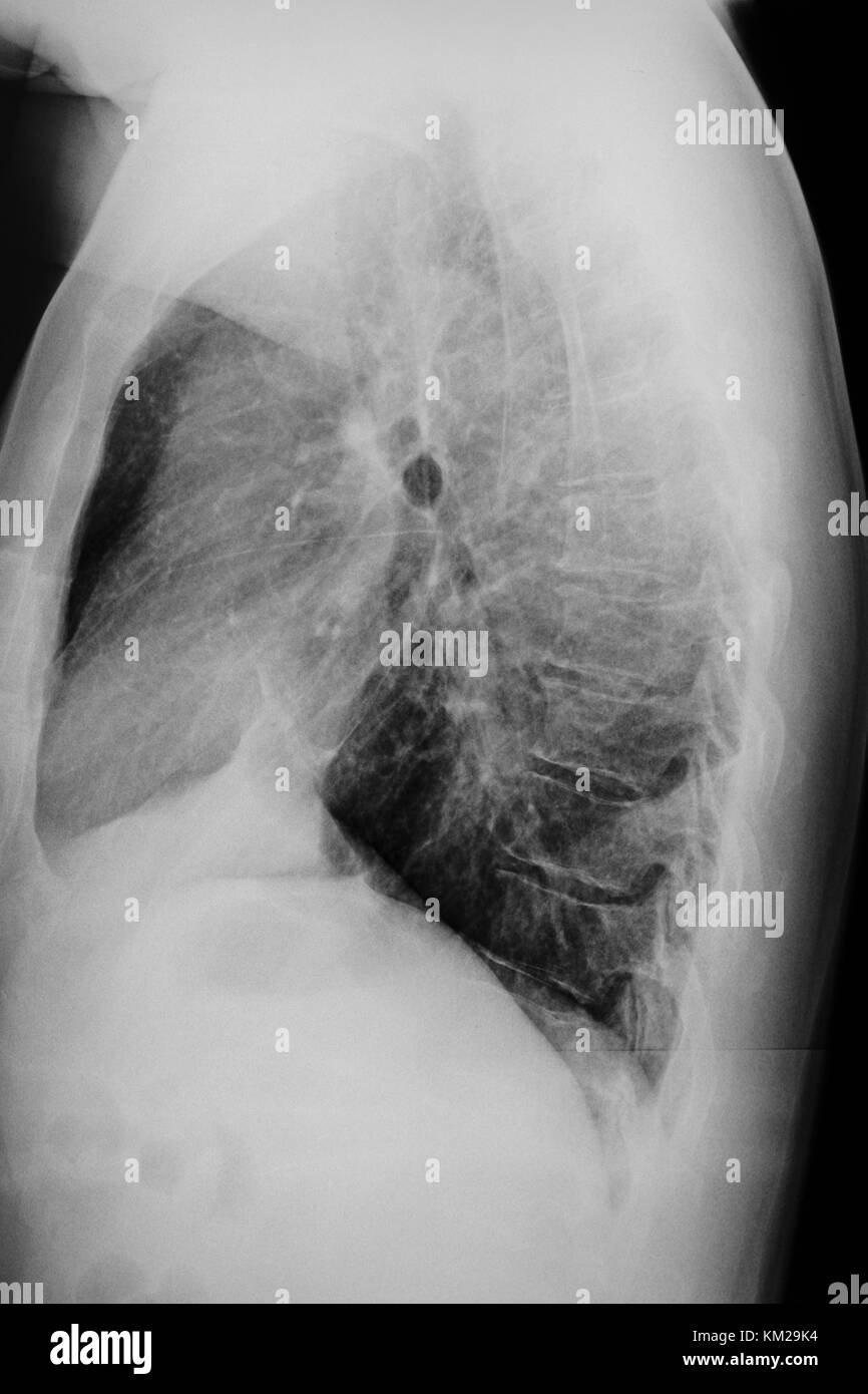 Pneumonia lungs x ray Black and White Stock Photos & Images - Alamy