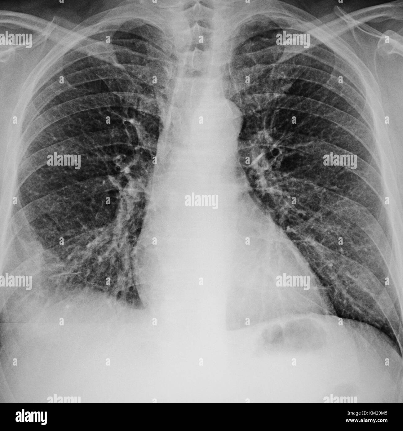 Pneumonia lungs Black and White Stock Photos & Images - Alamy