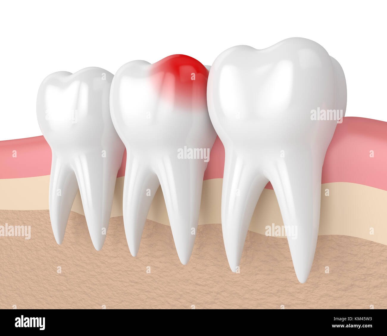 3d render of teeth with toothache in gums isolated over white ...