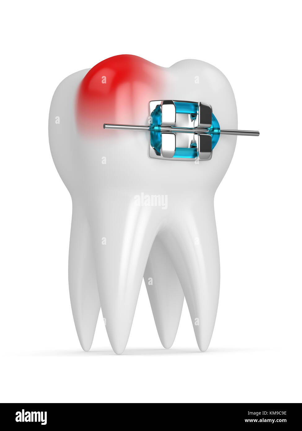 3d render of tooth with brace and toothache isolated over white ...