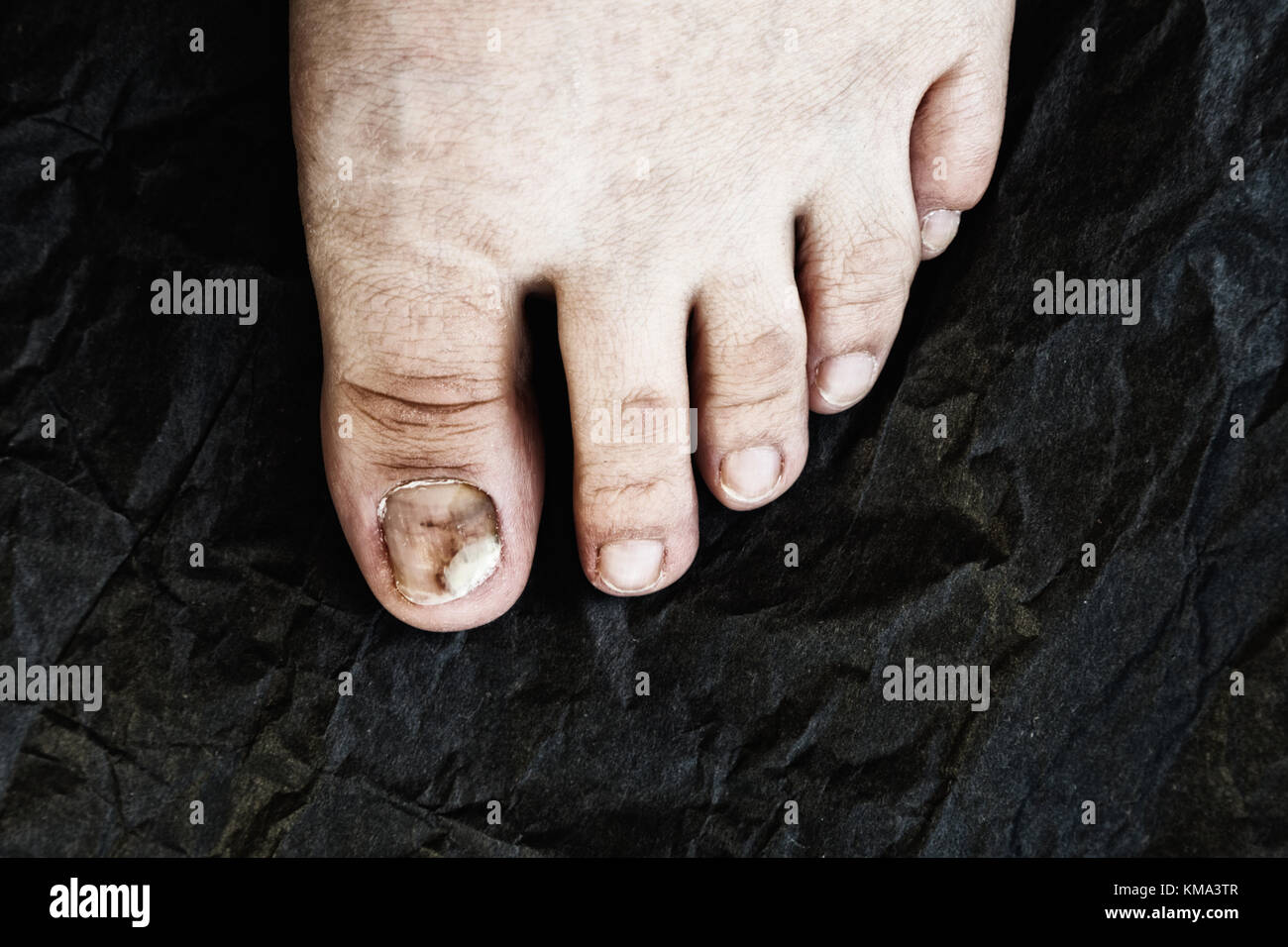 Dirty Toe Nails Stock Photos & Dirty Toe Nails Stock Images - Alamy