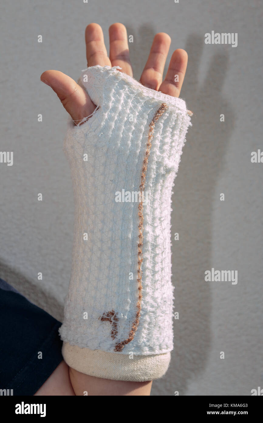 Eight Years Old Child Keeps Broken Arm in Gypsum Stock Photo - Alamy