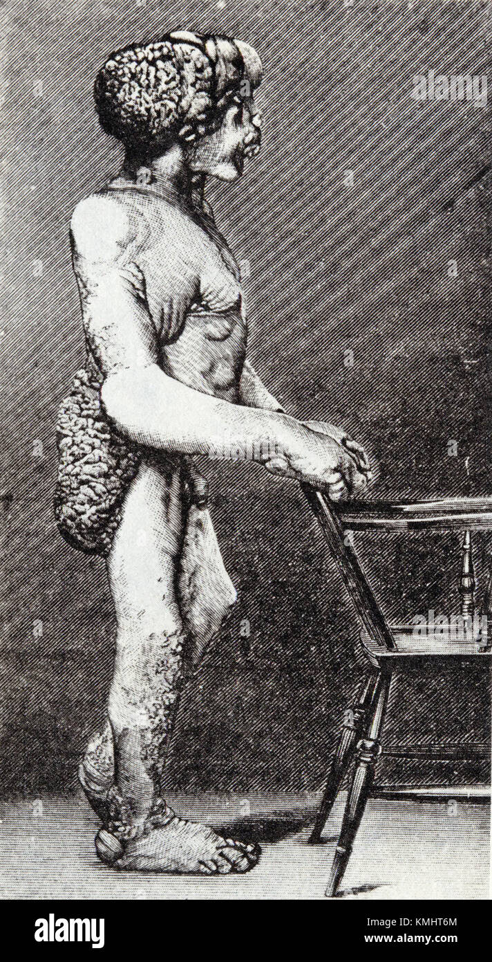 The elephant man hi-res stock photography and images - Alamy