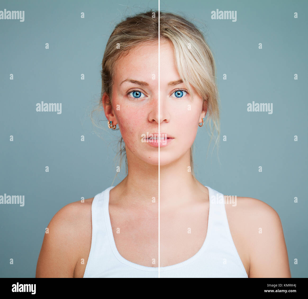 Young Model Woman with Skin Problem. Female Face Divided into two Parts ...