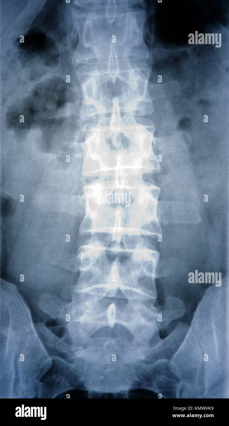 Bent spine hi-res stock photography and images - Alamy