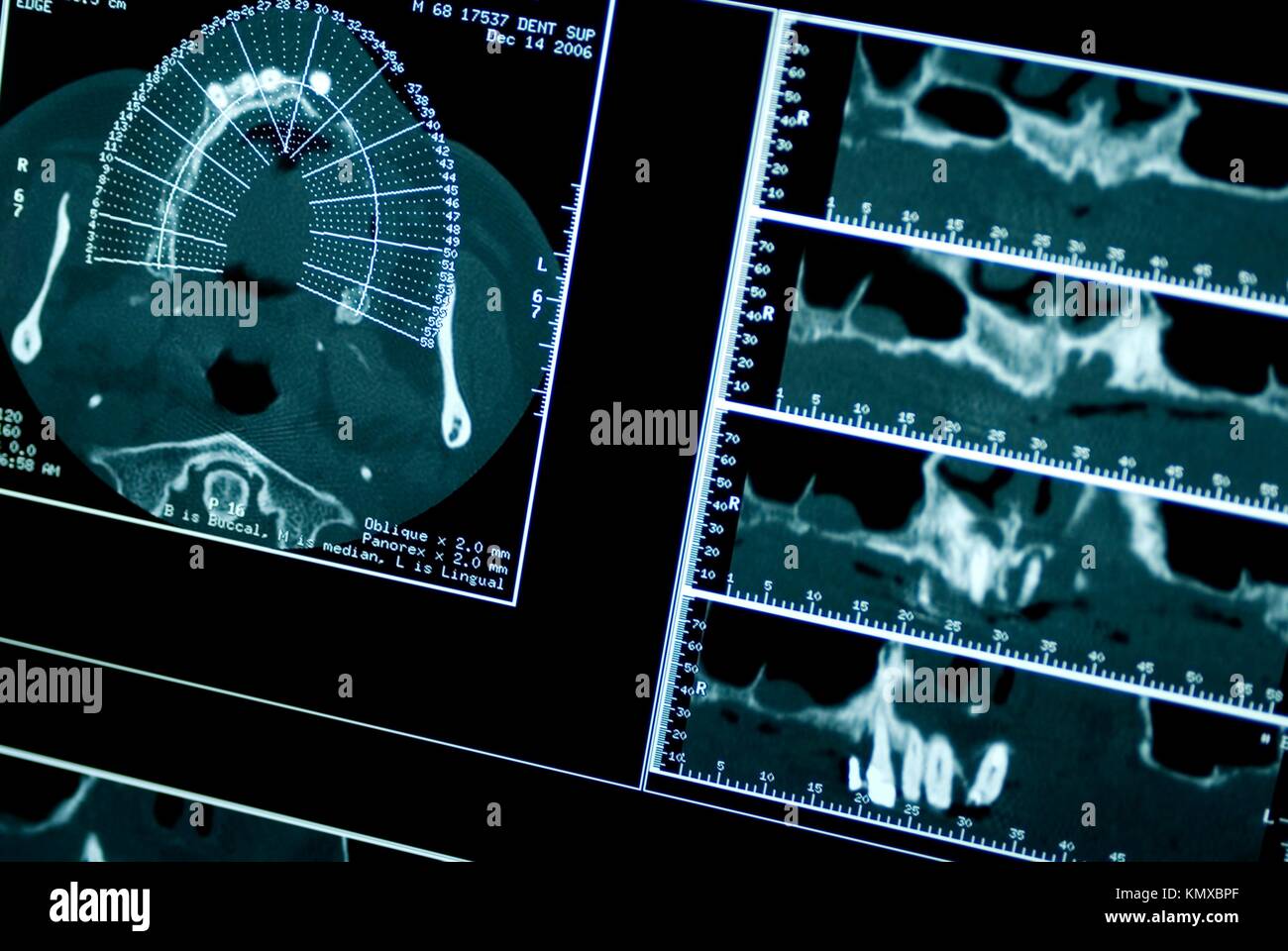 Radiography screen High Resolution Stock Photography and Images - Alamy