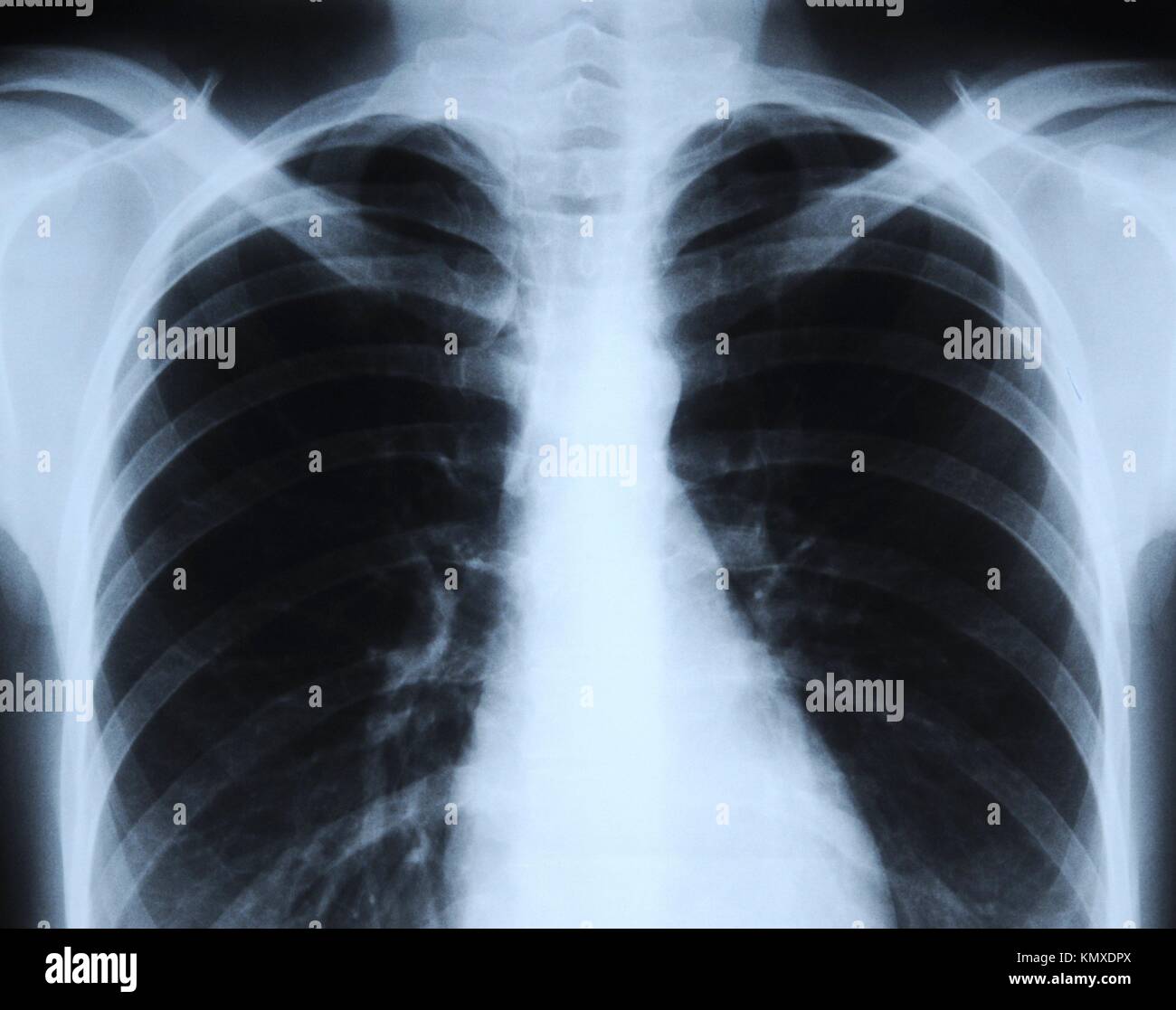 authentic x-ray picture of human chest Stock Photo - Alamy