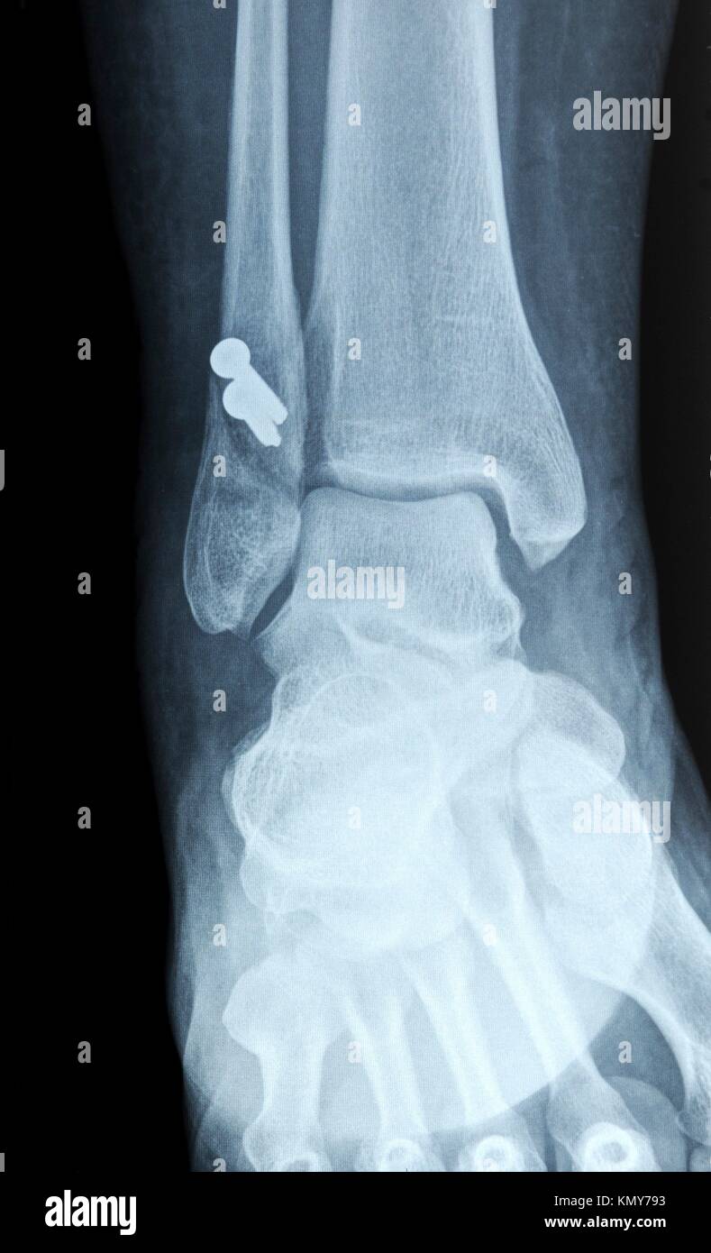 authentic x-ray picture of human fracture fibula bone with metal screws ...