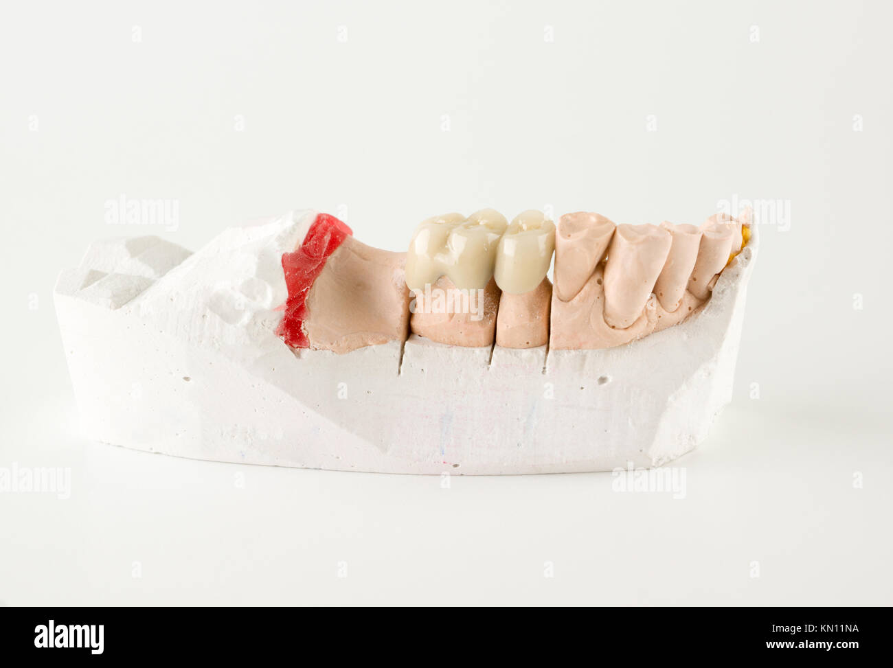 Artificial teeth are made of ceramics for the patient Stock Photo - Alamy