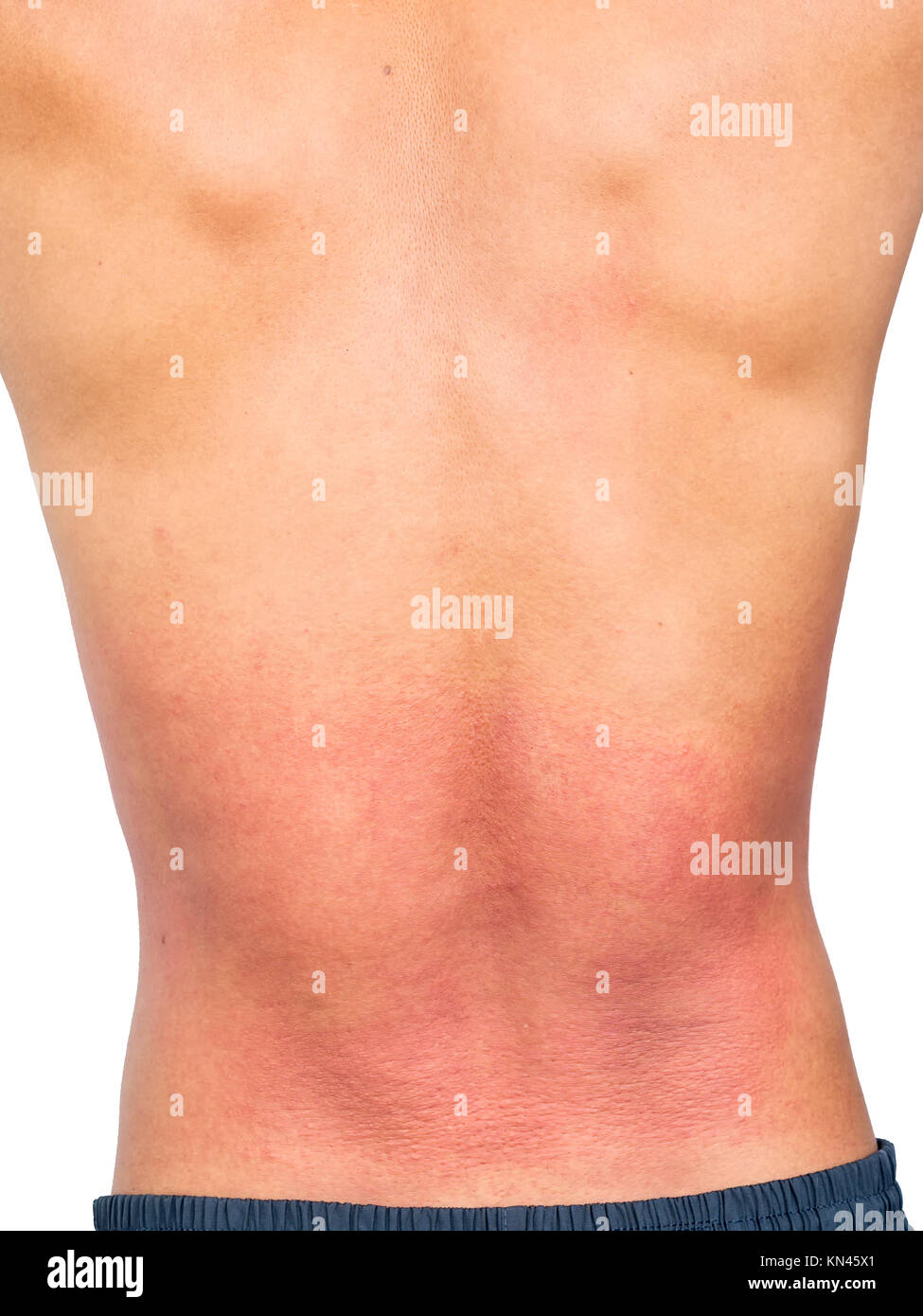 Skin allergy on back of man with white background Stock Photo - Alamy