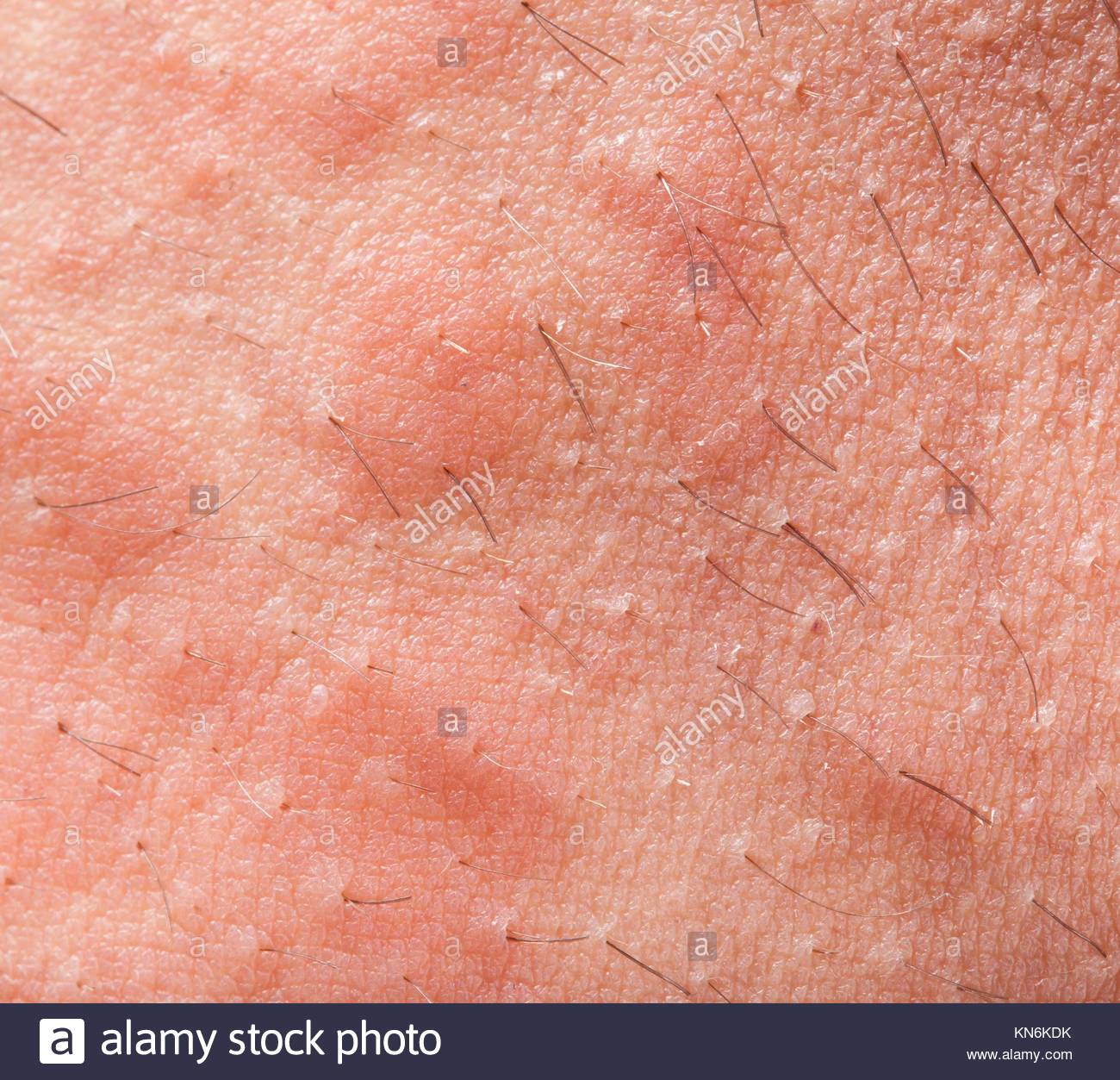 Dermatitis Stock Photos & Dermatitis Stock Images - Alamy