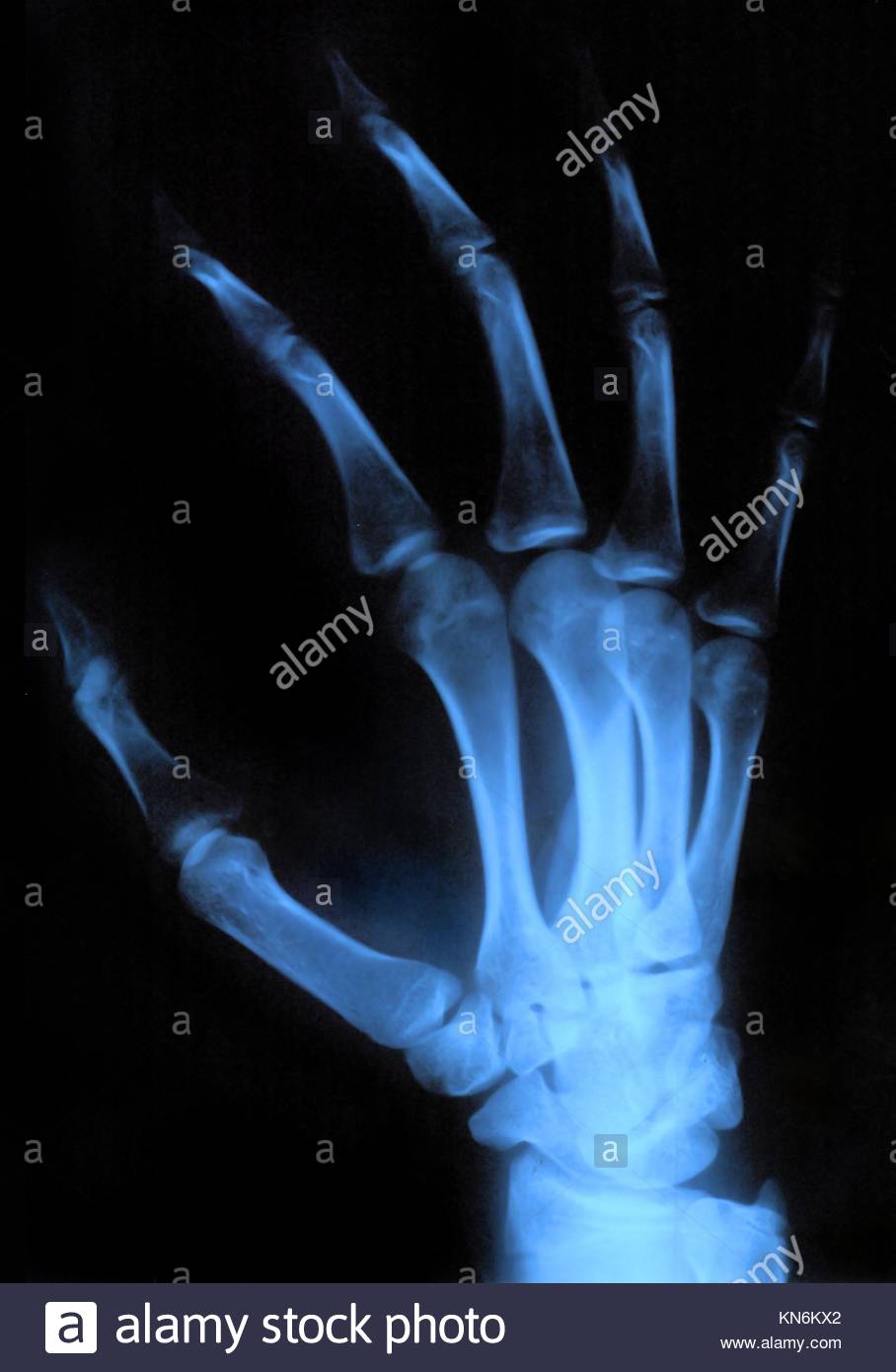 Broken Hand X Ray Stock Photos & Broken Hand X Ray Stock Images - Alamy