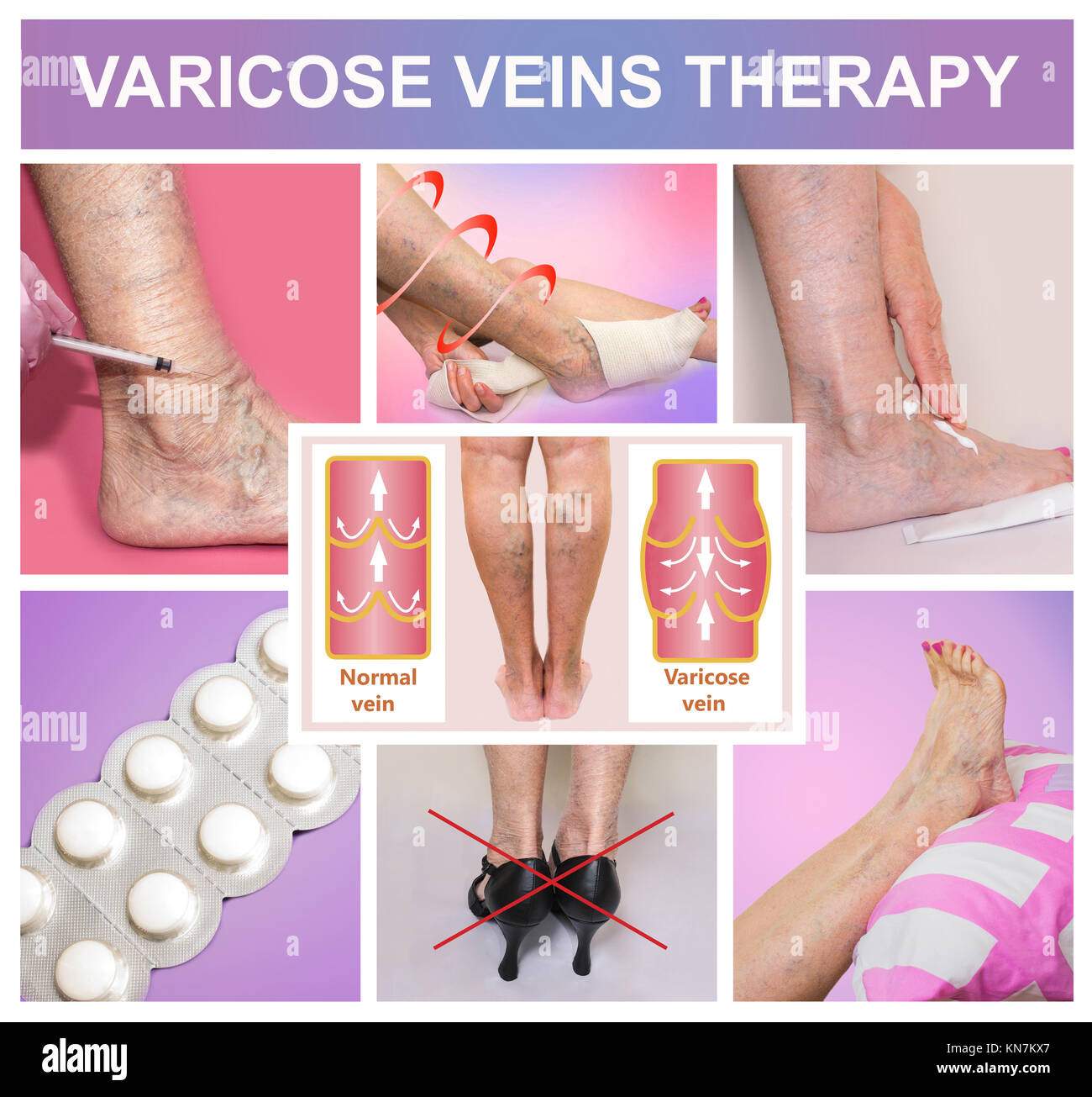 Treatment of varicose veins Stock Photo - Alamy