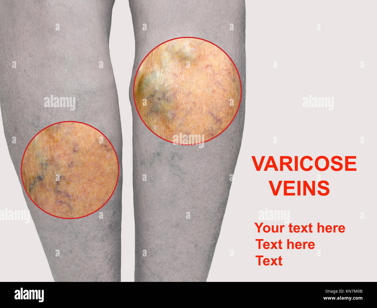 Painful varicose veins,,spider veins, varices on a severely affected ...