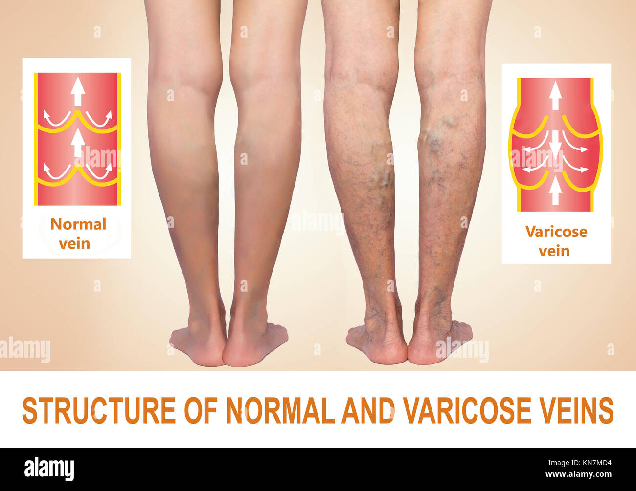 Varicose veins on a female senior legs. The structure of normal and ...