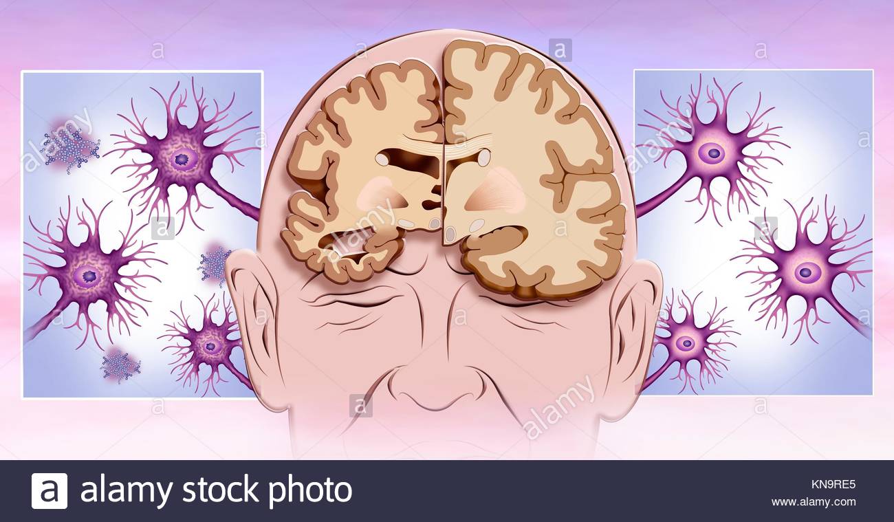 Alzheimer's Disease Brain Stock Photos & Alzheimer's Disease Brain ...