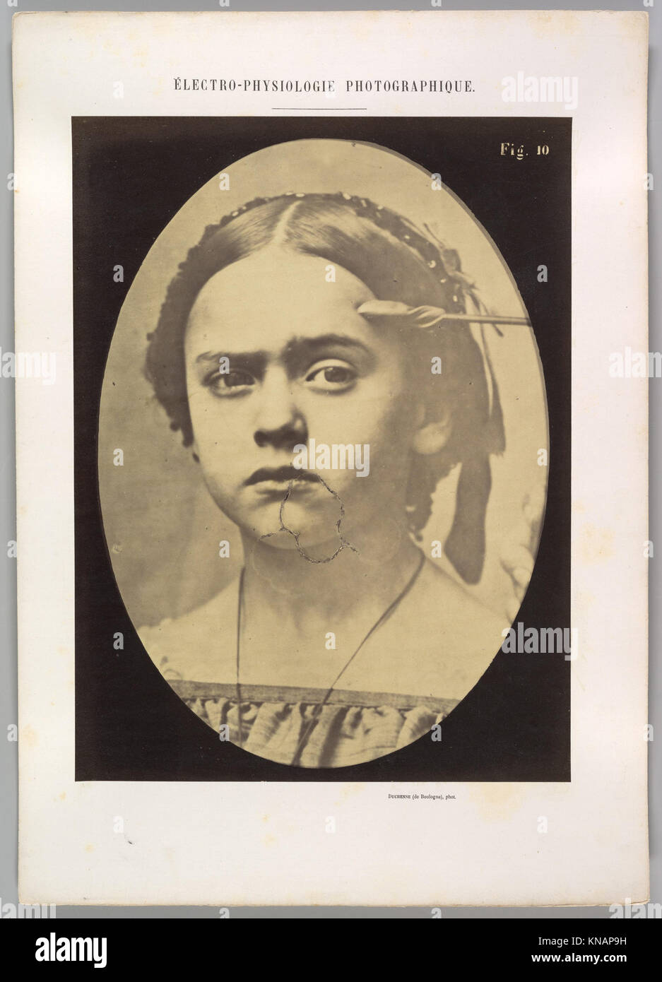 This figure, displaying the expressive lines of the m. frontalis ...