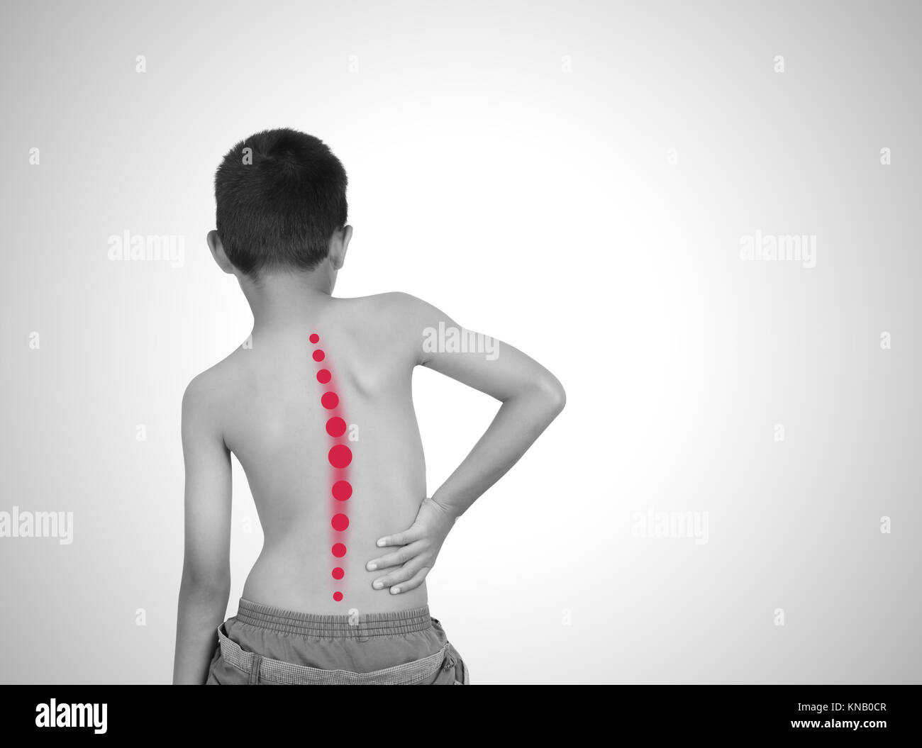 Scoliosis child hi-res stock photography and images - Alamy