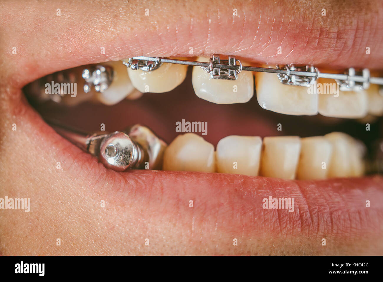 Dental appliance for deep bite Stock Photo - Alamy