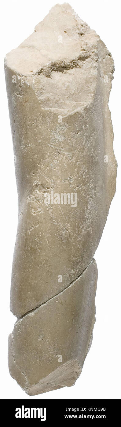 Illustration of an arm showing skeletal structure and anatomical ...