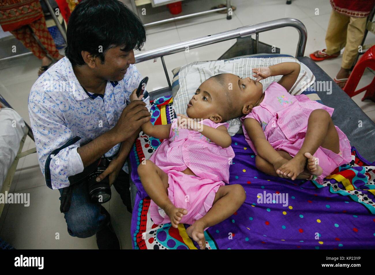 Conjoined twins baby hi-res stock photography and images - Alamy