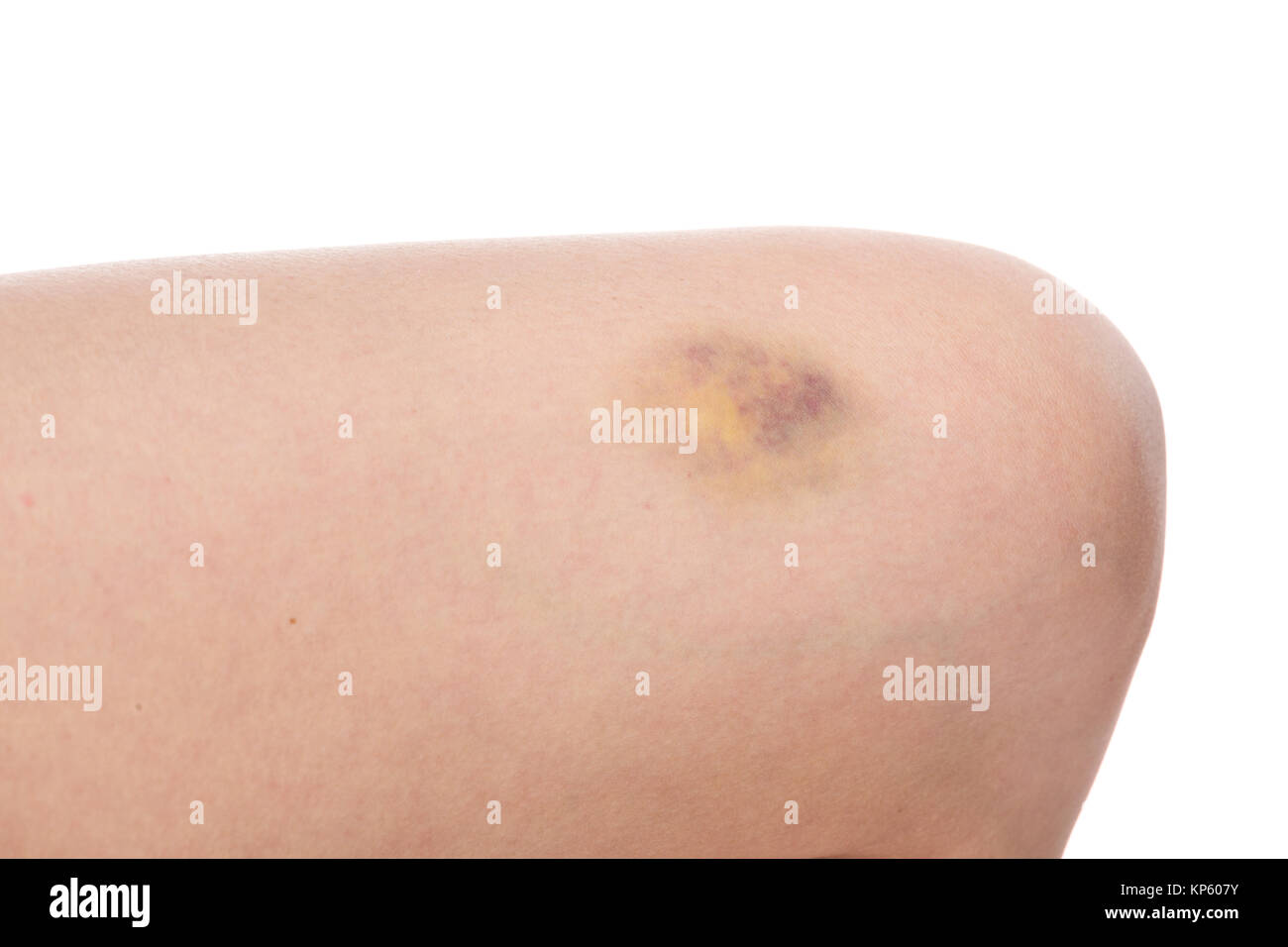 Bruise on wounded woman leg skin Stock Photo - Alamy